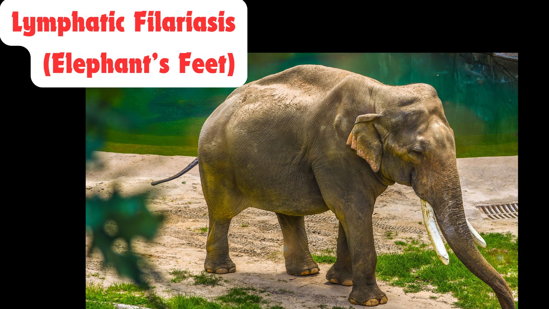Elephantiasis Treatment and Management - Info Hut